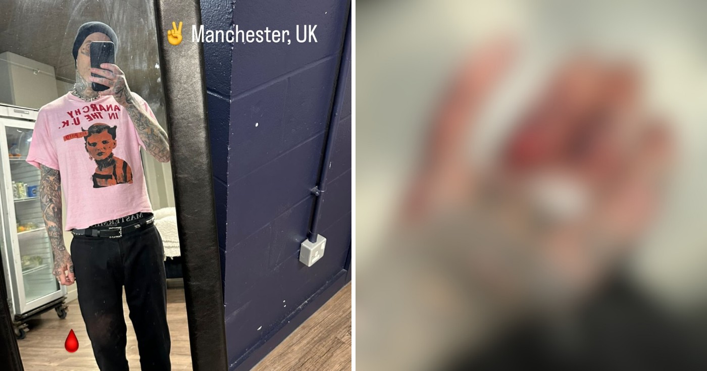 Travis Barker assusta fãs com foto chocante de dedos em carne viva após ...