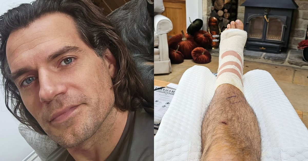 Henry Cavill mostra perna machucada em acidente que adiou filmagens de ...