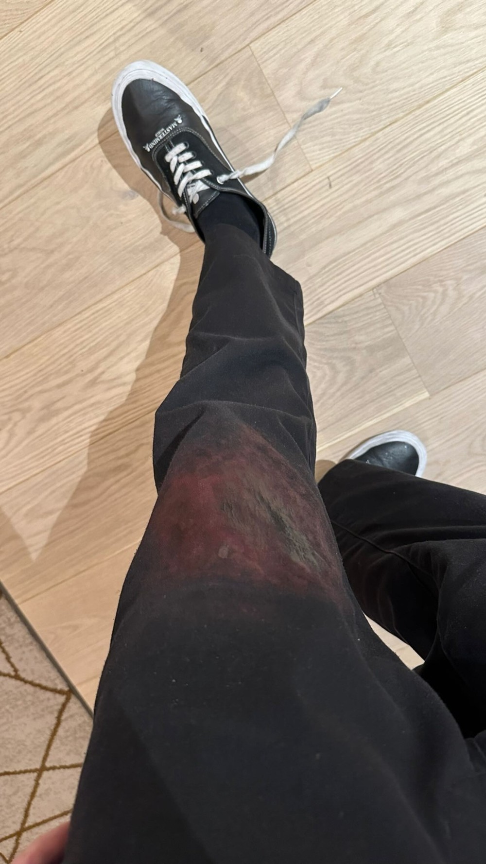 Travis Barker assusta fãs com foto chocante de dedos em carne viva após ...