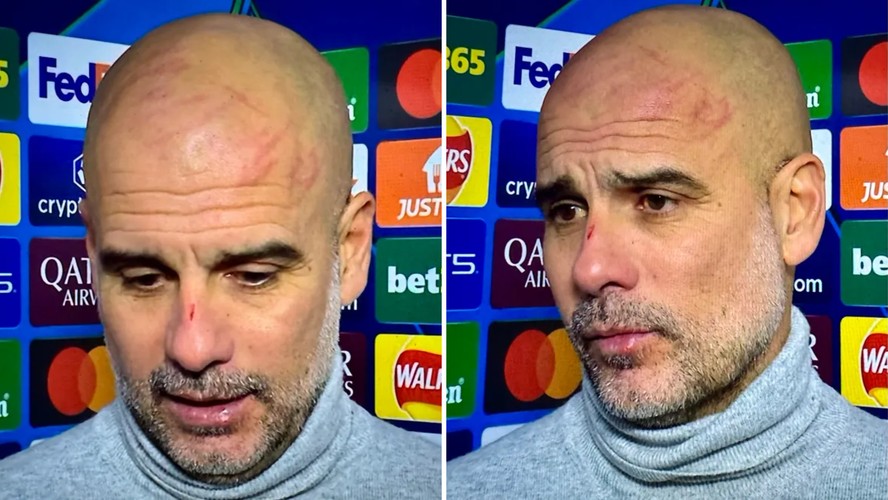 Guardiola posta texto sério após aparecer com marcas no rosto e dizer ...