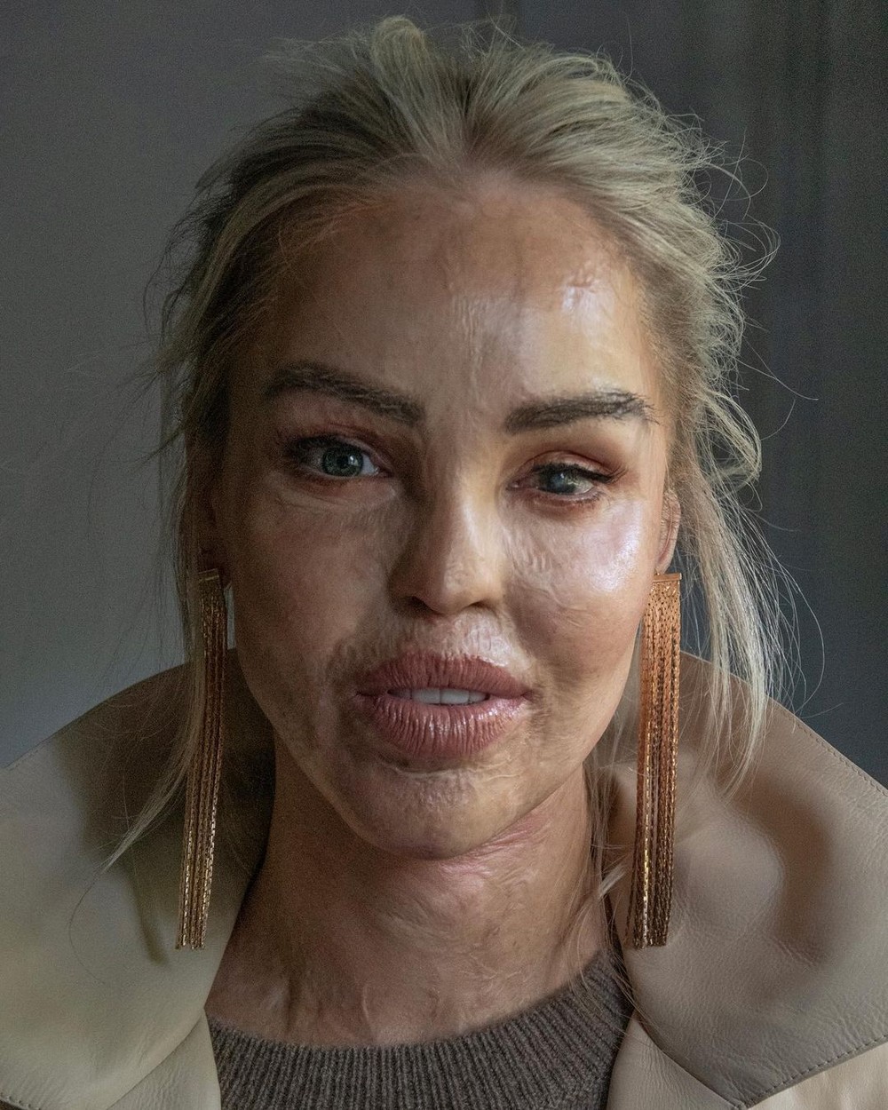 Apresentadora Katie Piper revela nova cirurgia para evitar 'perder o ...