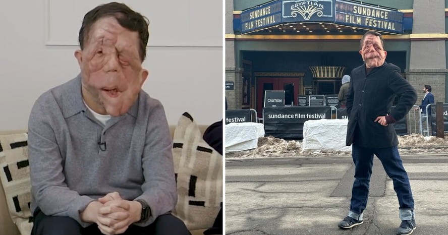 Ator com doença rara diz que 'roteiros preguiçosos' perpetuam ...