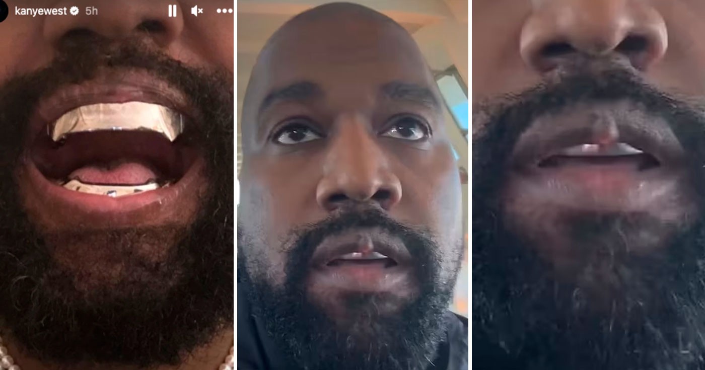 'Caroço' no lábio de Kanye West após prótese dentária de R$ 4,2 milhões ...
