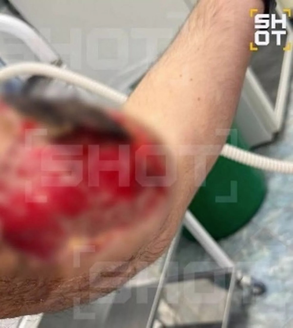 Influencer conhecido como 'Popeye russo' pode perder os dois braços ...