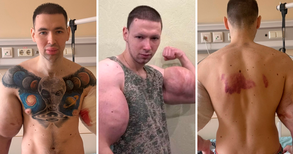 'Popeye Russo', influencer famoso pelos músculos ‘impossíveis’, é hospitalizado para ‘retirada ...