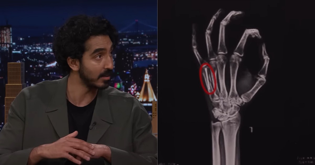 Dev Patel, astro de 'Quem Quer Ser um Milionário', revela ter quebrado ...