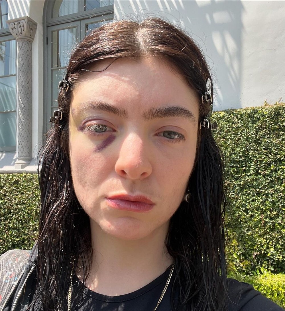 Lorde posa com olho roxo em selfies após 'limpar' redes sociais e ...