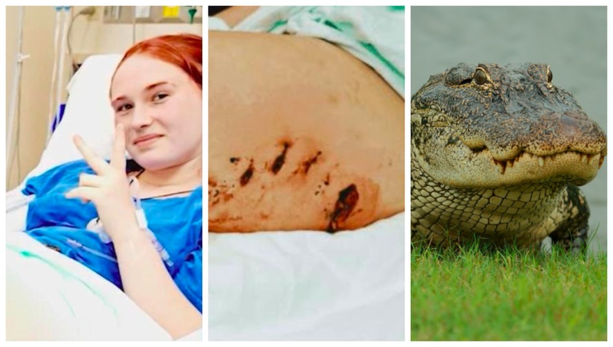 Jovem de 15 anos mostra cicatriz gigante na perna como troféu após ...