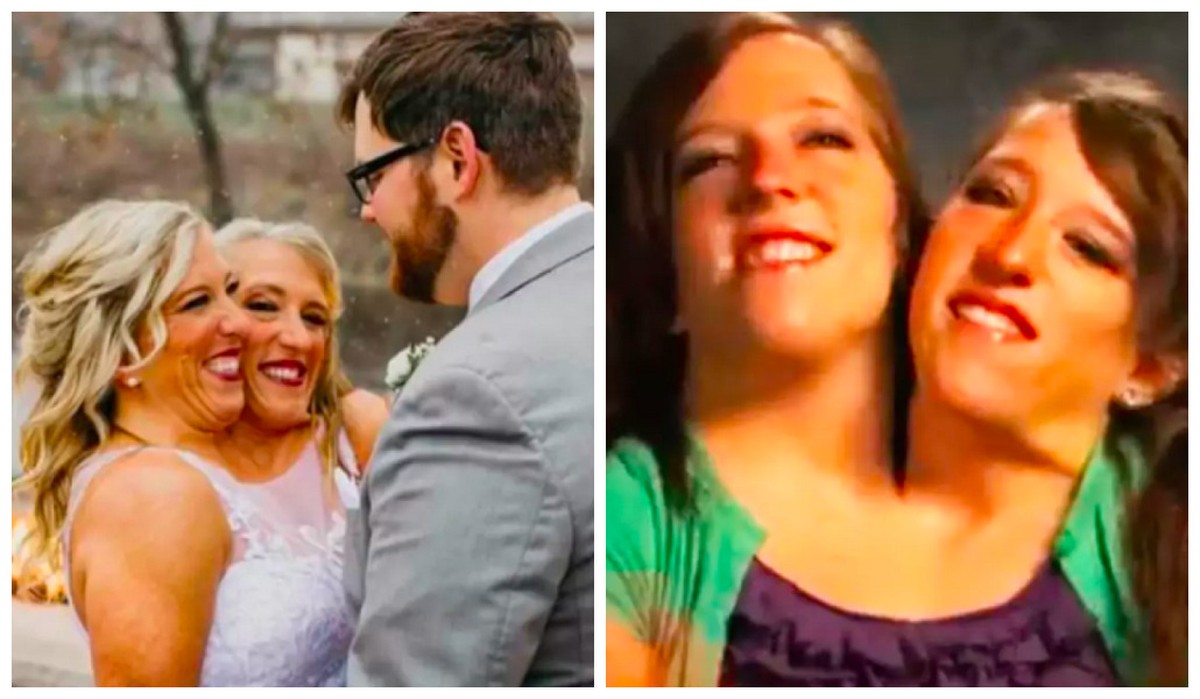 Irmãs siamesas que tiveram vida retratada em reality show revelam casamento