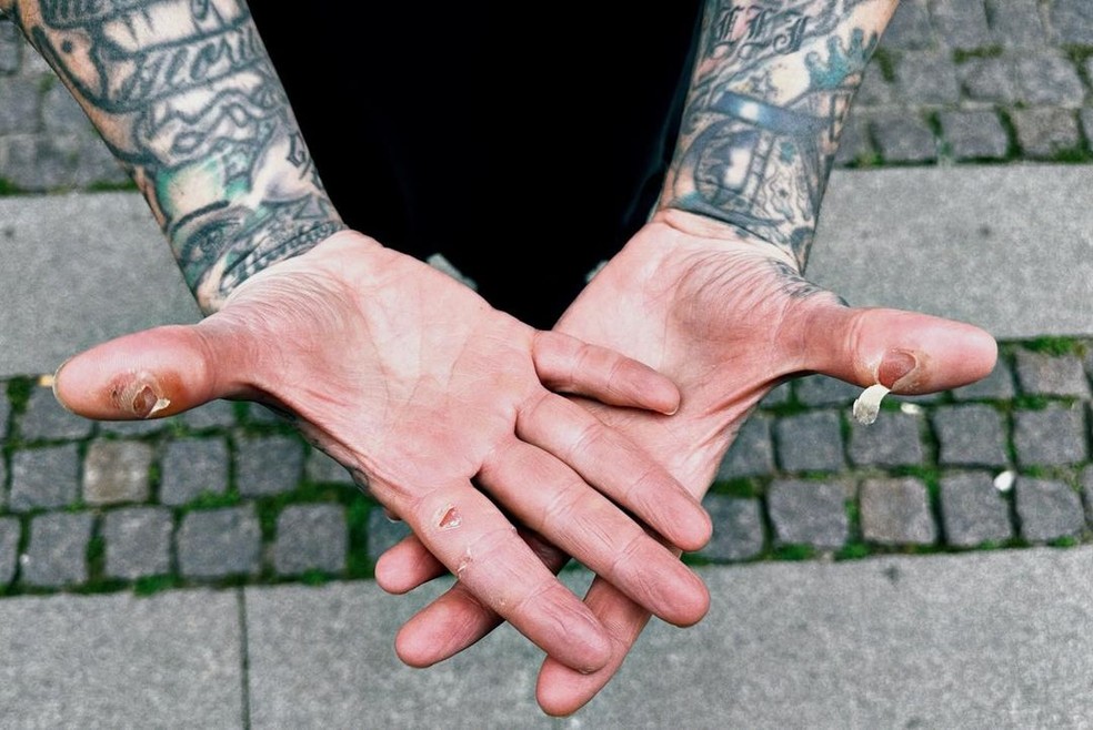 Travis Barker assusta fãs com foto chocante de dedos em carne viva após ...