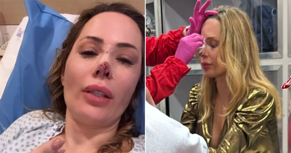 Influencer brasileira é atacada por cachorro no México e tem ponta do nariz arrancada: 'Achei ...