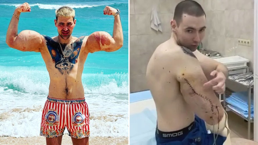 Influencer conhecido como 'Popeye russo' pode perder os dois braços ...
