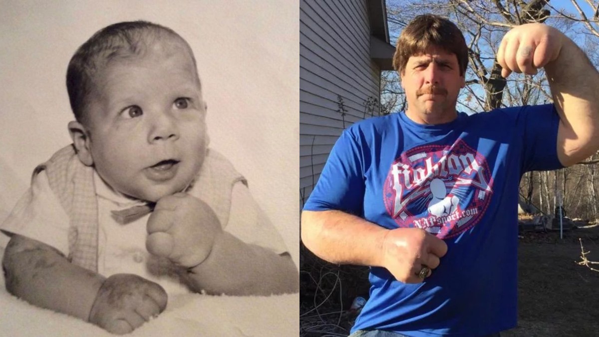 'Popeye da vida real' mostra fotos da infância para provar que nasceu ...